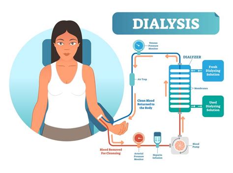 Image result for Dialysis Explained
