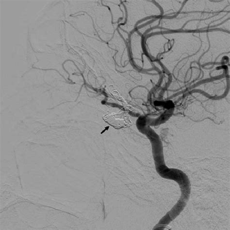 Image result for Angiogram with Embolization