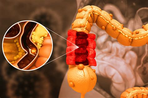 Image result for Colonoscopy Colon Cancer Polyps