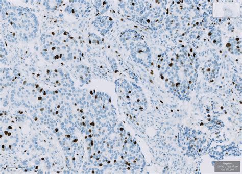 Image result for Tissue Microarray Multiplex IHC NCR