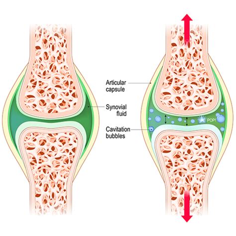 Image result for Joint cracking Risks