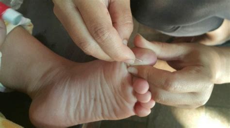 Image result for Body Removing Splinter