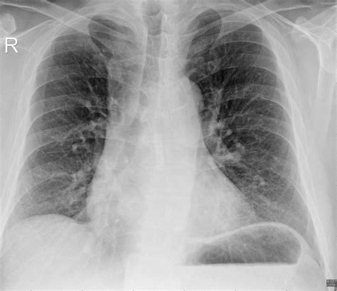 Image result for Loop Recorder Chest XR