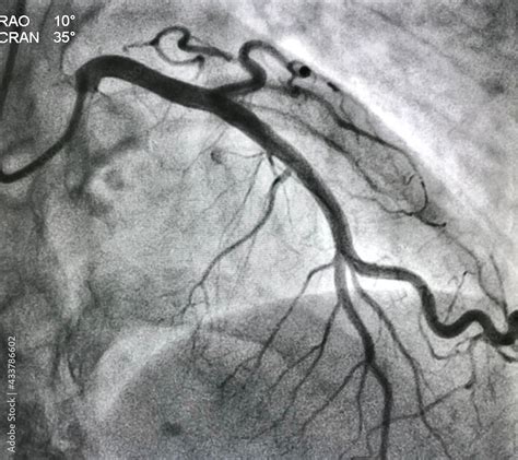 Image result for Normal Coronary Angiogram