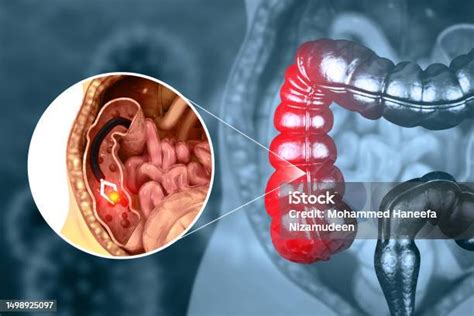 Image result for Control Colonoscopy of Polyps