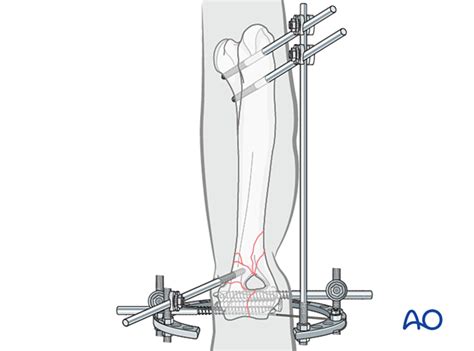 Image result for External Fixator Surgery