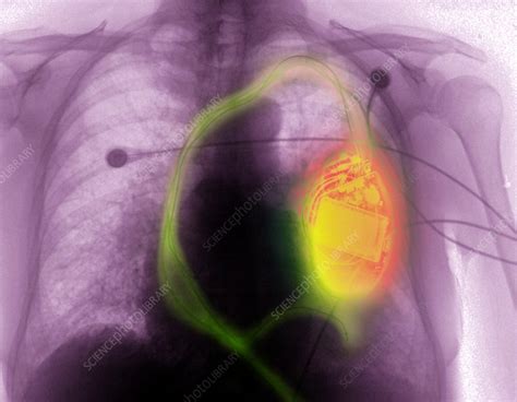 Image result for Remove a Pacemaker and Install Defibrillator