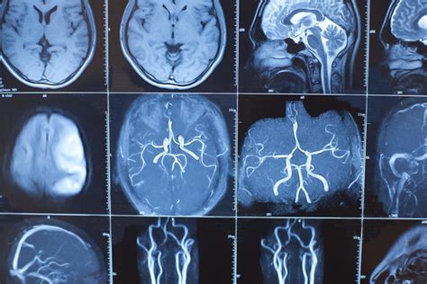 Image result for Different Types of Angiogram