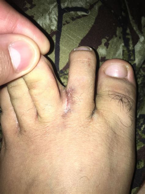 Image result for Cellulitis Toe