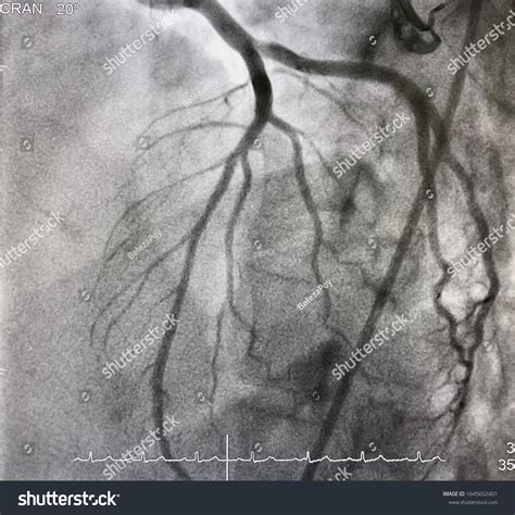 Image result for Normal Coronary Angiogram