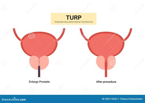 Image result for Transurethral Procedure