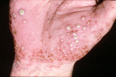 Image result for Types of Pustular Psoriasis