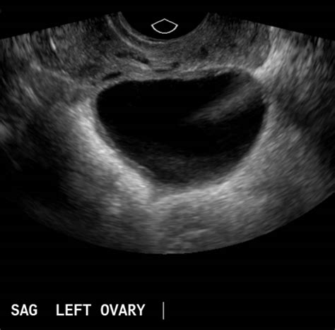 Ovarian Cyst Types - Symptoms, Pain, Diagnosis & Treatment - Face Surgery