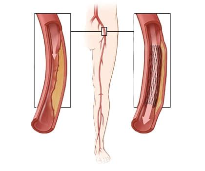 Image result for Peripheral Angiogram