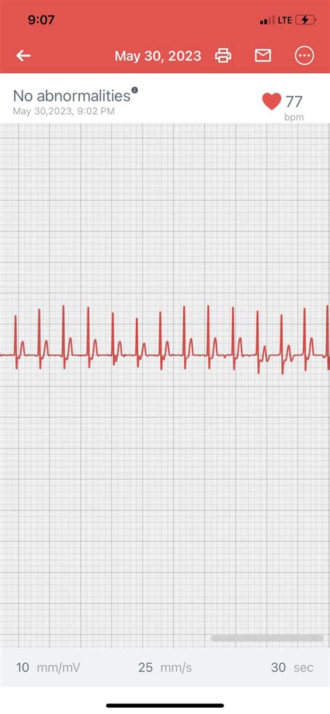 Image result for Types of ST Depression