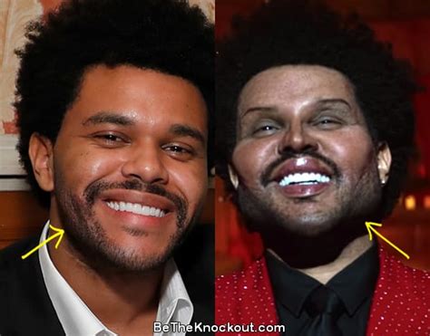 Image result for The Weeknd Botox