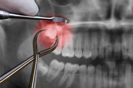 Image result for DIY Teeth Removal