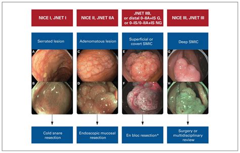 Image result for Colonoscopy Clips for Polyps
