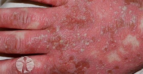 Image result for Types of Pustular Psoriasis