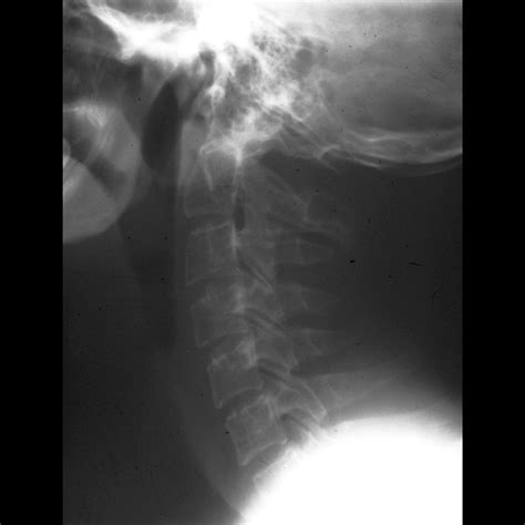 Image result for X-Rays for Basilar Invagination