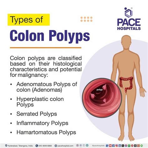 Image result for Colonoscopy Polyps Types