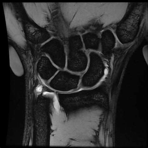 Image result for Wrist Arthrogram