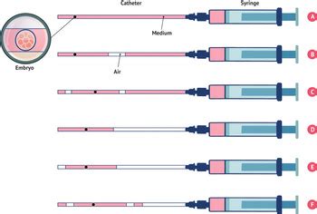 Image result for Watch Embryo Transfer