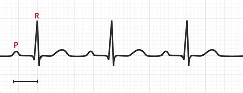 Image result for PR Interval Abnormalities