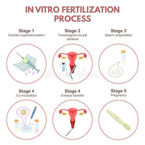 Image result for In Vitro Fertilization Procedure Step by Step