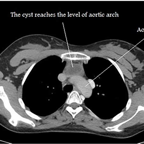 Image result for Big Exploding Cyst Neck