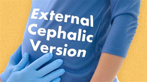 Image result for External Cephalic Version Step by Step