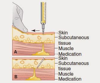 Intramuscular Injection Z-Track Method ~ Nursing
