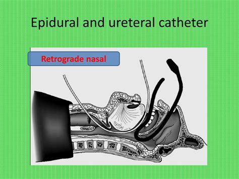Image result for Retrograde Intubation