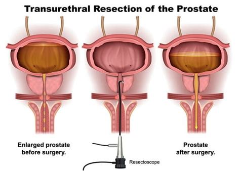 Image result for Prostate Operation Procedure