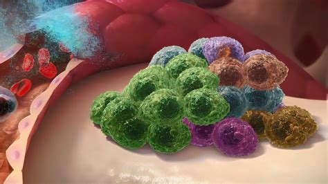 Image result for Diffuse Large Cell Lymphoma