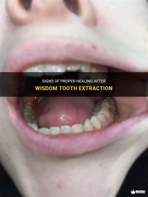 Image result for Wisdom tooth Extraction