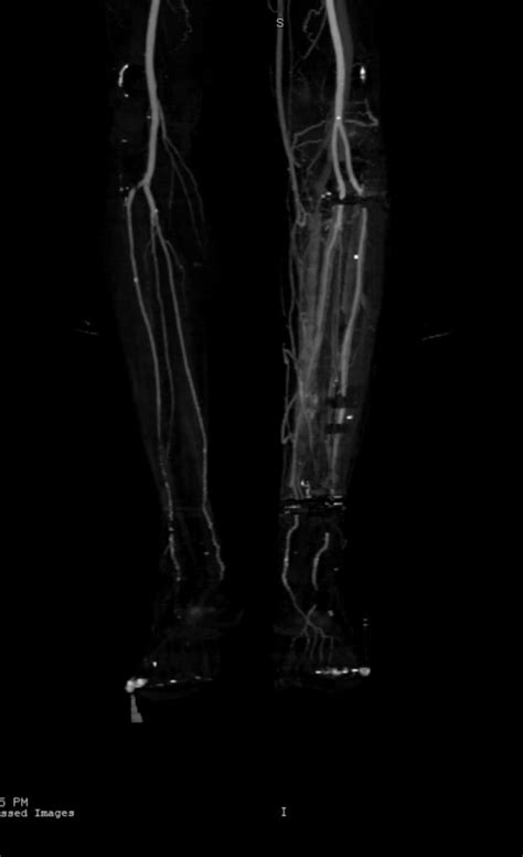 Image result for Left Lower Extremity Angiogram
