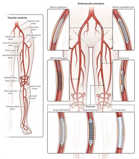 Image result for Peripheral Angiogram