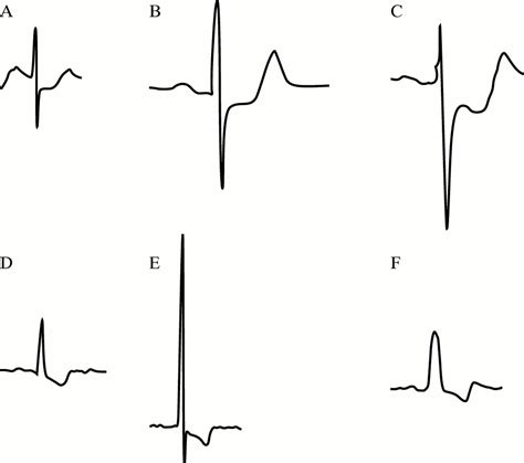Image result for Types of ST Depression