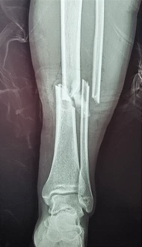 Image result for External Fixator Surgery