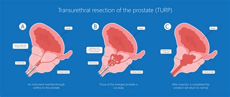 Image result for Transurethral Procedure