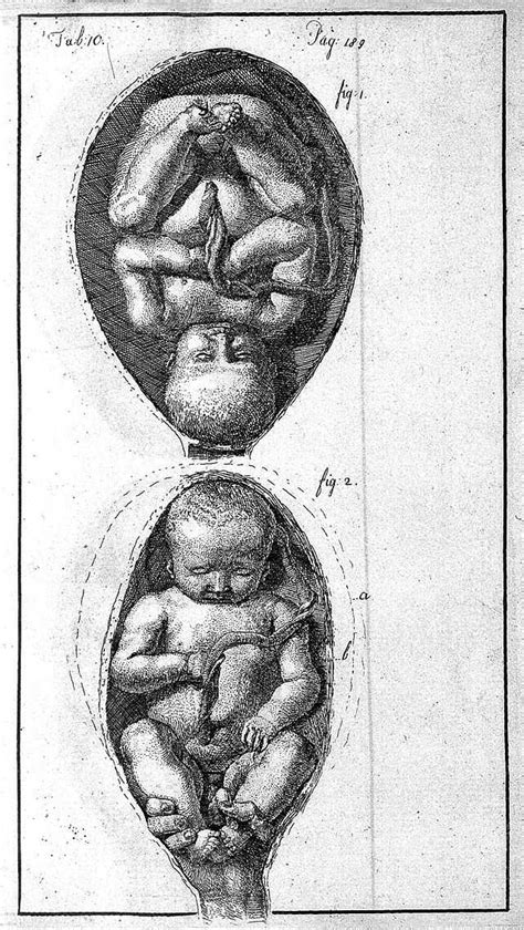 External cephalic version - Wikiwand