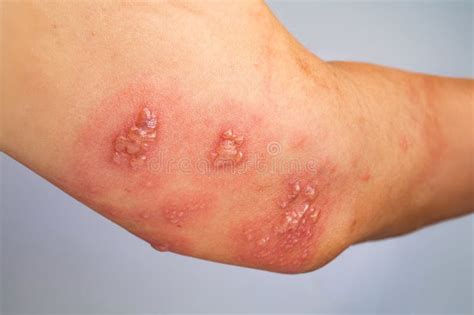 Image result for Shingles On Arm