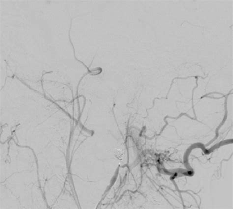 Image result for Angiogram with Embolization