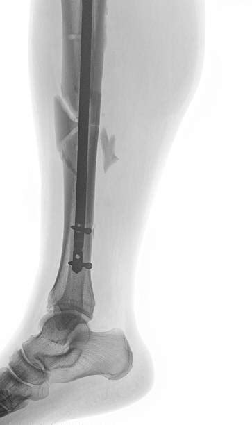 Image result for Splinter Foot