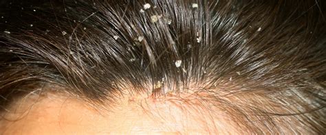 Image result for Treating Seborrhea