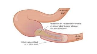 Image result for Intussusception in Arabic