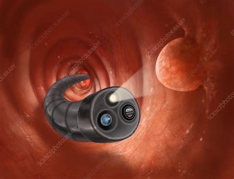 Image result for Colonoscopy Polyps Tutorial