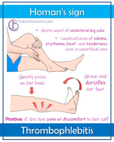 Image result for Positive Homans Sign