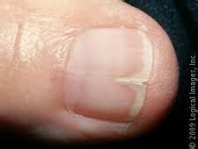 Image result for Help for Splitting Nails Shea Butter
